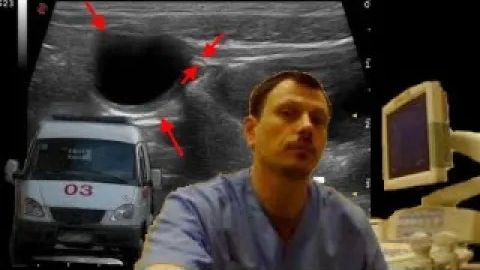 Детское УЗИ мочевого пузыря - Дивертикул мочевого пузыря