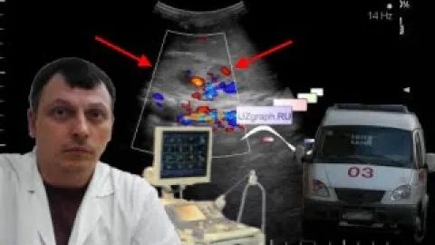 Детское УЗИ почек и брюшной полости -  Нейробластома. Диффузная инфильтрация печени