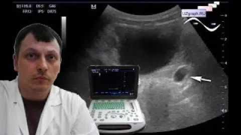 Детское УЗИ мочеточников - Транзиторный двухсторонний мегауретер