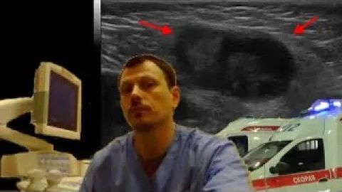 Детское УЗИ мягких тканей - Ущемленная паховая грыжа с яичником