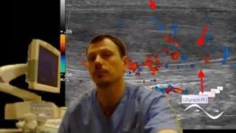 УЗИ костно-мышечной системы - Утолщение ахиллова сухожилия