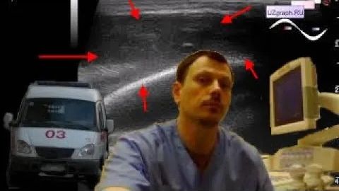 Детское УЗИ костей - Кефалогематома