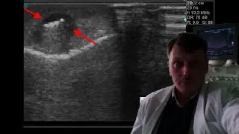 УЗИ мягких тканей - Почему нельзя спать в серьгах