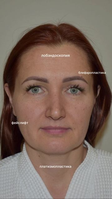 ДО/ПОСЛЕ: комплексное омоложения лица и шеи