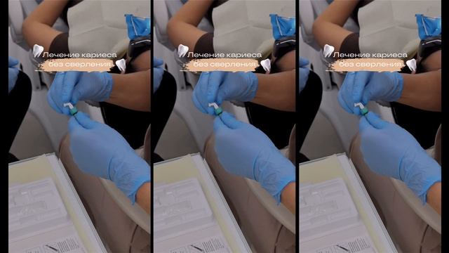лечение кариеса без сверления