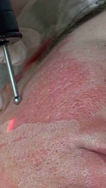 Лазерная шлифовка при акне