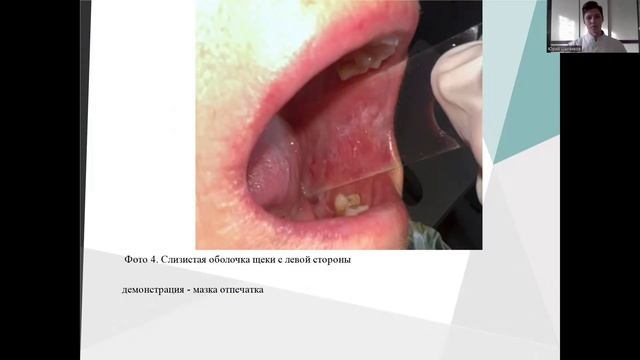 ЭФФЕКТ ЛЕЧЕНИЯ КРАСНОГО ПЛОСКОГО ЛИШАЯ