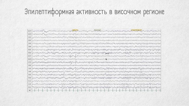 ГЕНОФОНД #10. «ЭЭГ видео мониторинг»
