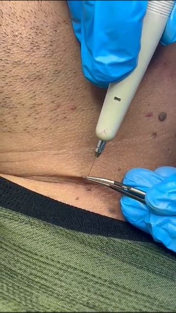 Удаление папиллом, родинок, новообразований: Новосибирск, Кабинет Красоты Ларисы Екименко