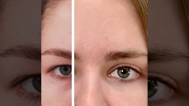 #блефаропластика: до и после