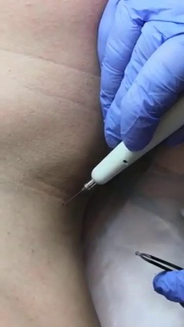 Удаление папиломы в Новосибирске!