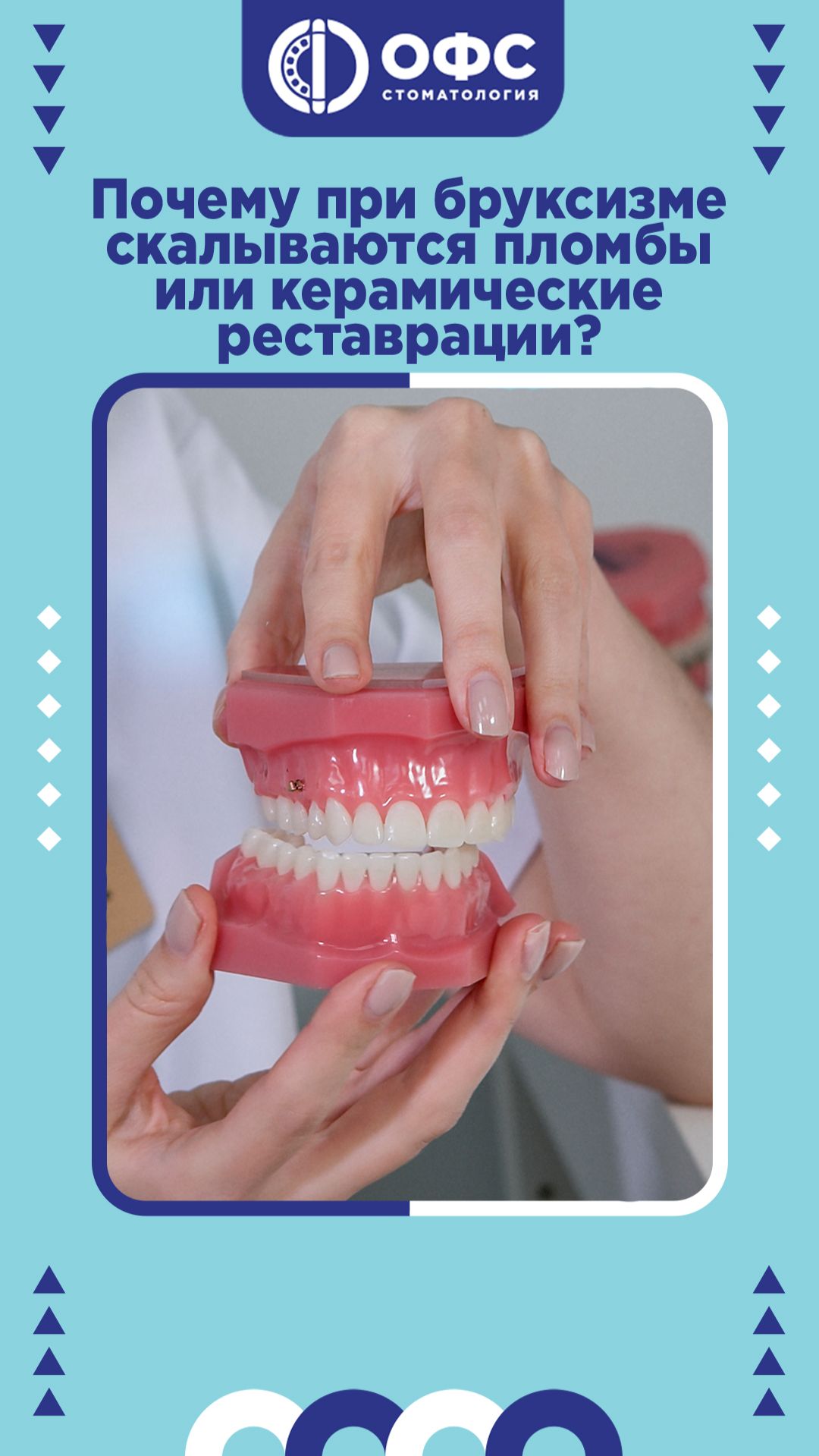 Почему при бруксизме скалываются пломбы или керамические реставрации?