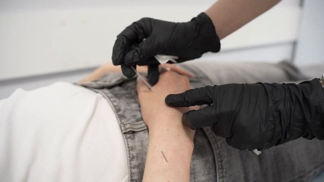 Как проходит сеанс Акупунктуры у невролога в "Медикал"