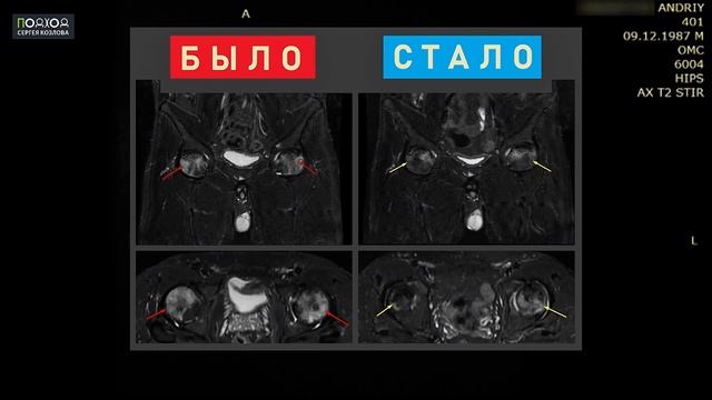 Фаза №1 восстановления суставов от асептического некроза. Отёк костного мозга на МРТ проходит
