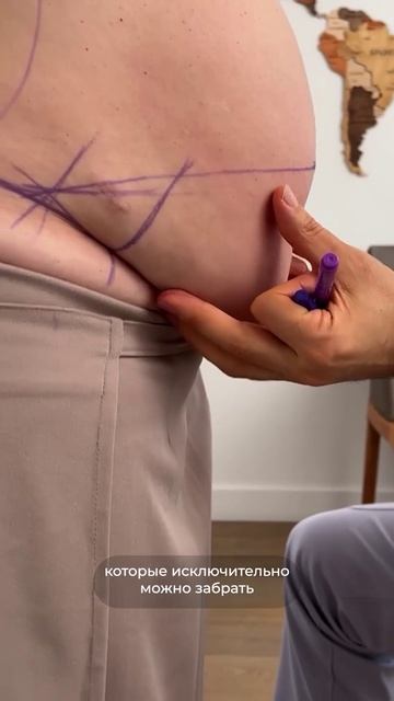 КОМПЛЕКСНАЯ АБДОМИНОПЛАСТИКА ПРИ ВЫПИРАЮЩЕМ ЖИВОТИКЕ. Часть 1. Доктор Карапетян