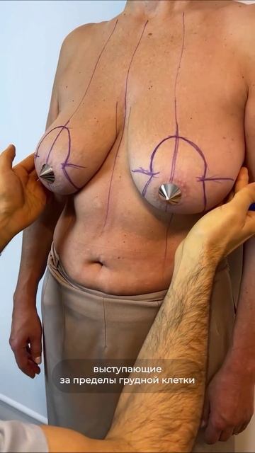 КОМПЛЕКСНАЯ ОПЕРАЦИЯ НА ЛИЦЕ И ГРУДИ ДЛЯ ПАЦИЕНТКИ ИЗ АМЕРИКИ. Доктор Карапетян