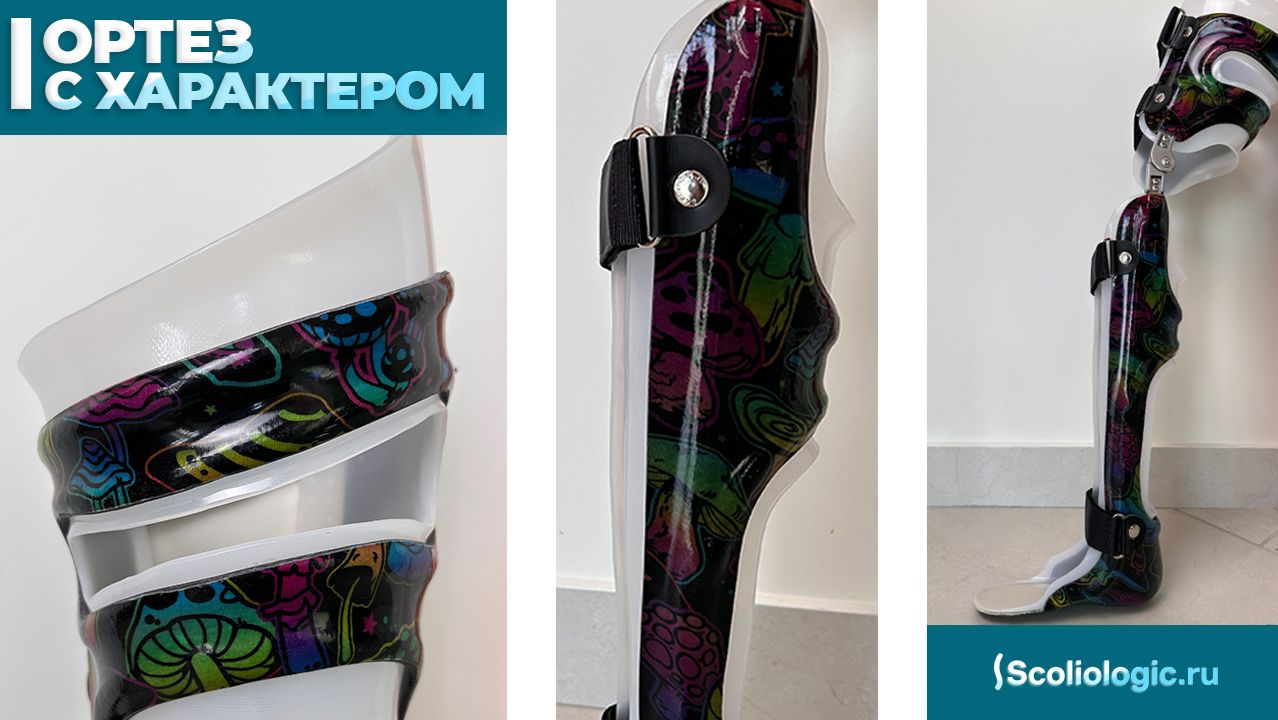 У девушка одна нога короче другой на 15 см