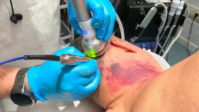 Лазерное удаление сосудистых пятен