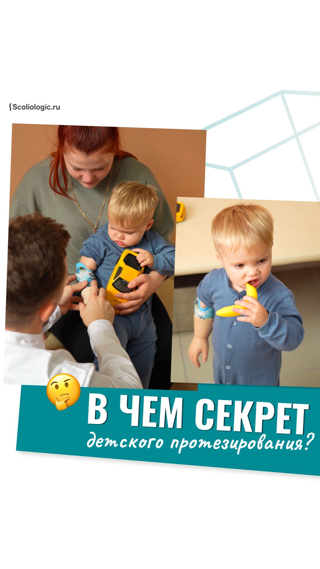 Детский протез руки