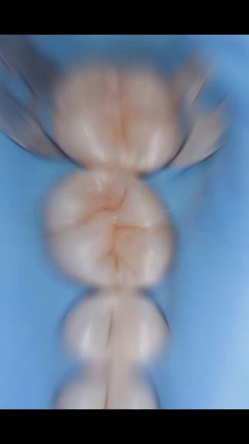 Когда нужно менять старые пломбы? #dentist #стоматология #пломба  #кариес  #лечениезубов