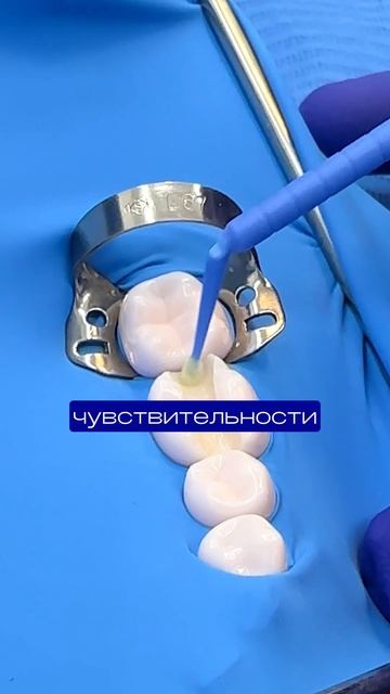Правильная реставрация II класса композитами #Tokuyama #стоматология #реставрация #dentist
