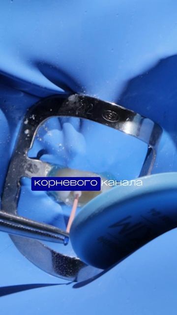 Самый важный этап эндодонтического лечения! #эндодонтия #лечениезубов #каналы #кариес #пульпит