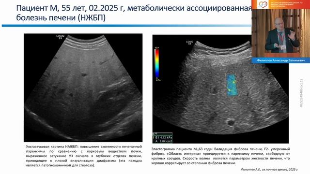 Сложные и простые вопросы в новых клинических рекомендациях по лечению атеросклероза (29.03.25.)