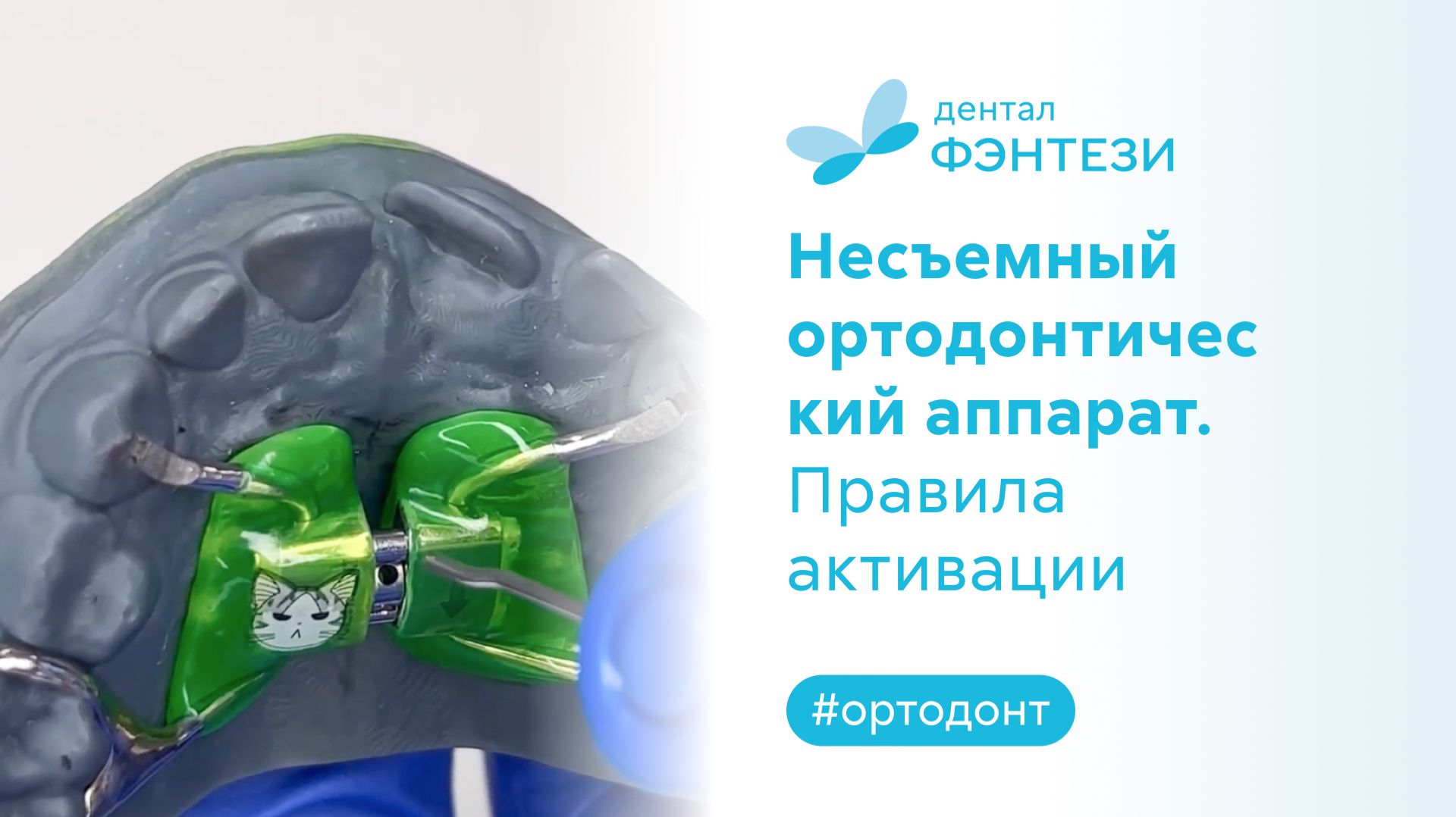 Несъемный ортодонтический аппарат. Правила активации для родителей
