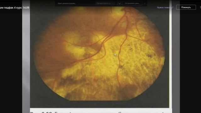 Лекция ЗАБОЛЕВАНИЯ СОСУДИСТОЙ и СЕТЧАТОЙ ОБОЛОЧЕК  14_09_2021