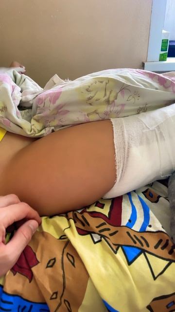 Третий день после операции активизируем мышцы передней поверхности ￼бедра ￼