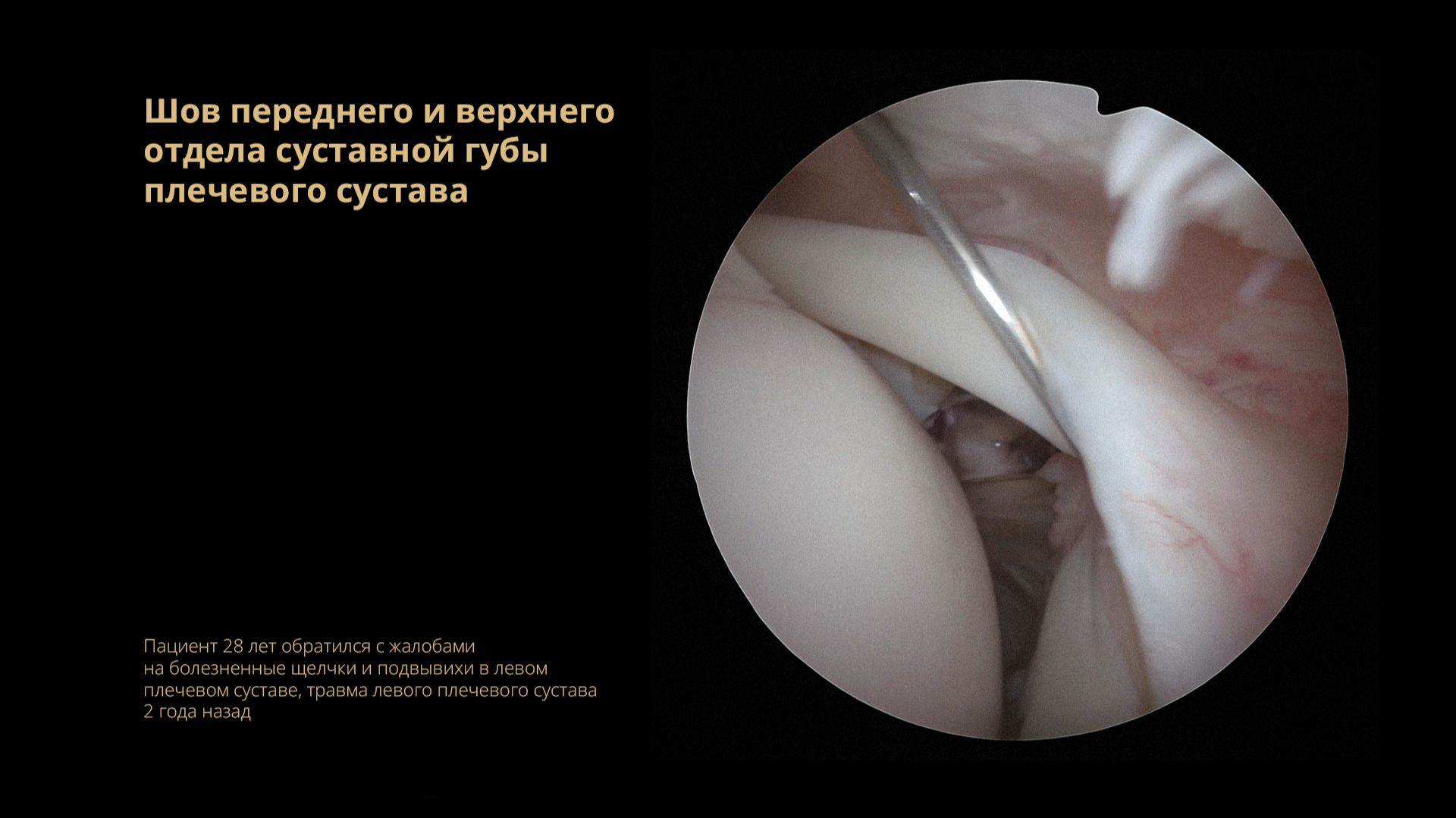 Шов переднего и верхнего отдела суставной губы плечевого сустава
