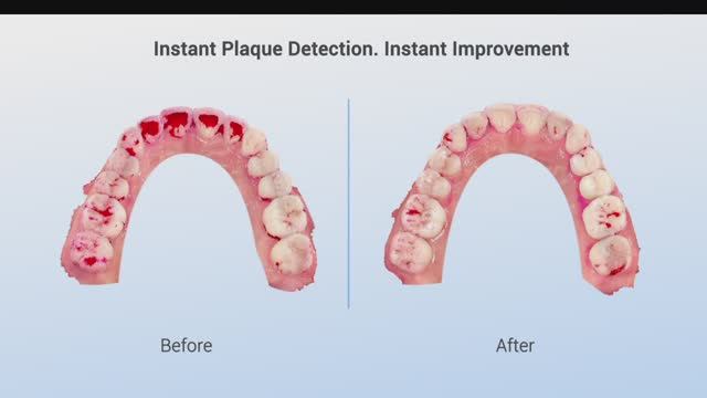 Гигиена полости рта с помощью Aoralscan ELF