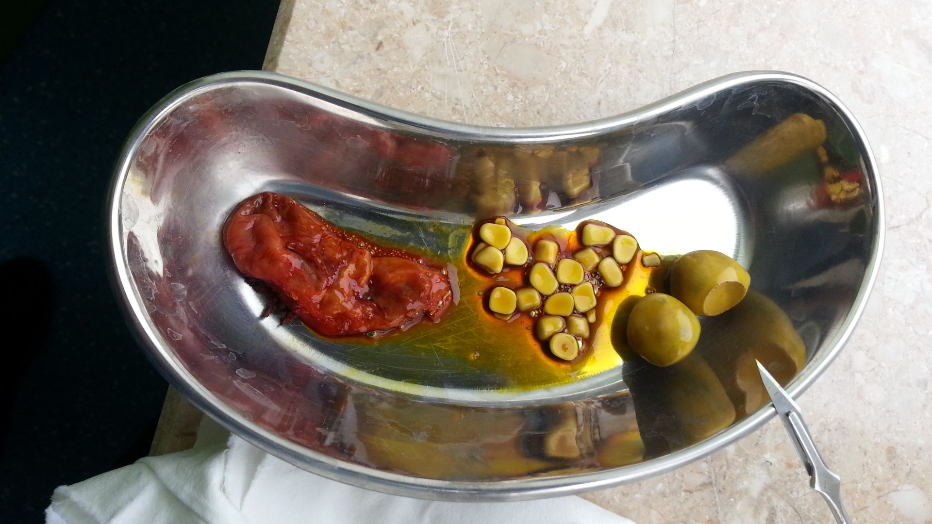 КАМНИ В ЖЕЛЧНОМ ПУЗЫРЕ.