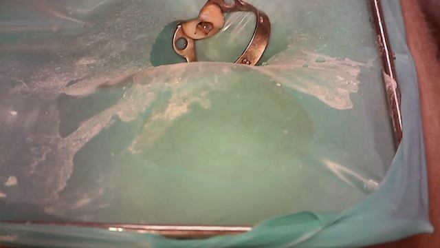 Извлечение латуневого штифта ультразвуком в 24 зубе. #ultrasonic#ультразвуквстоматологии