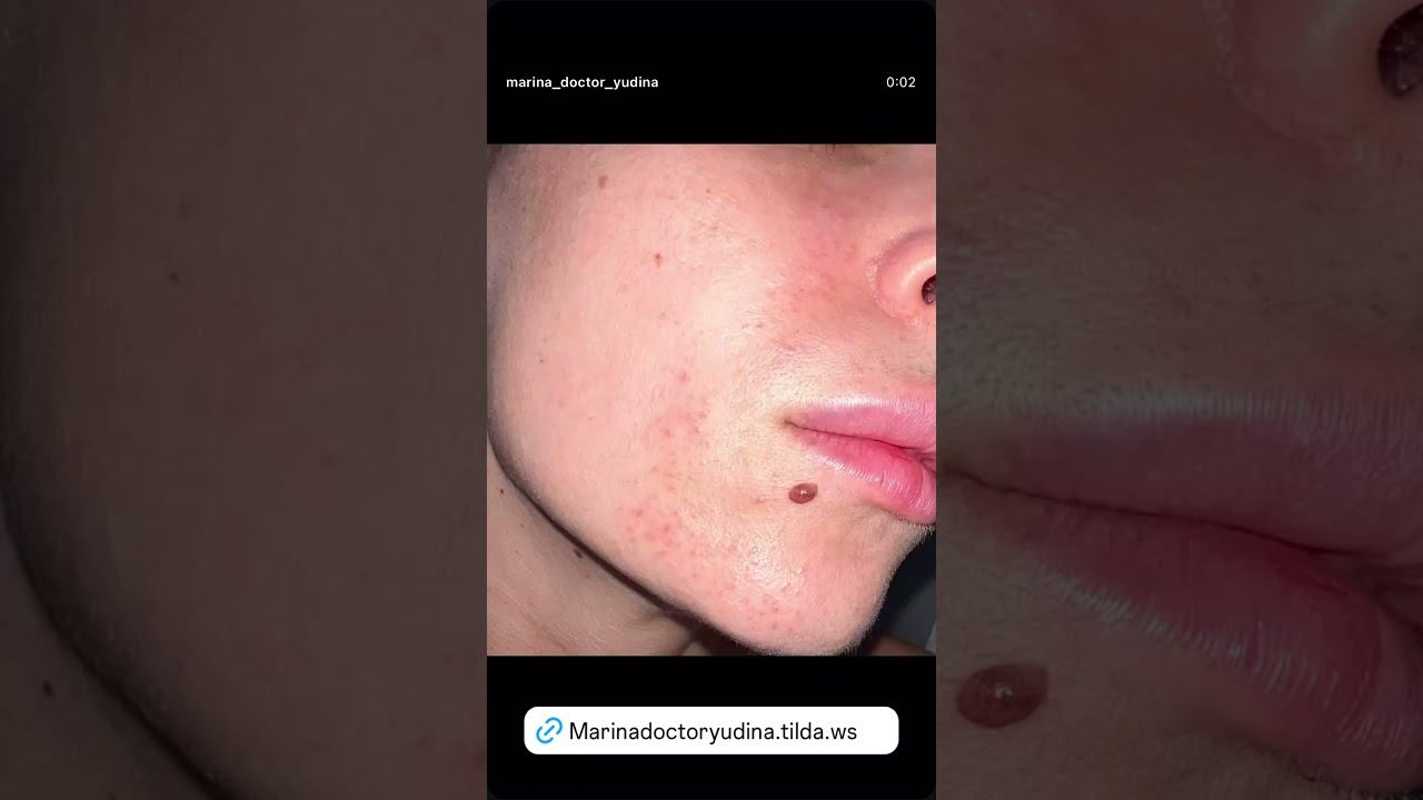 ДО и ПОСЛЕ лечения у доктора Юдиной М.М.