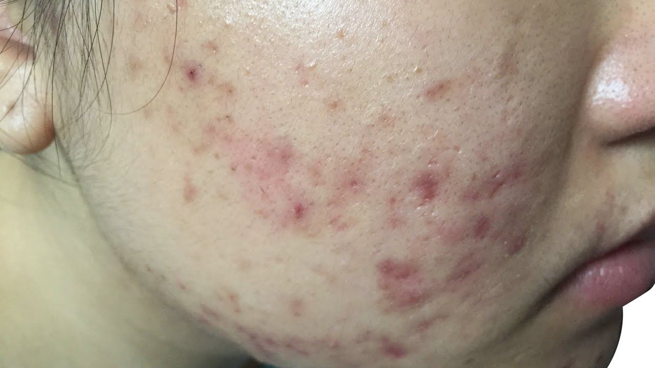 Почему начинается АКНЕ