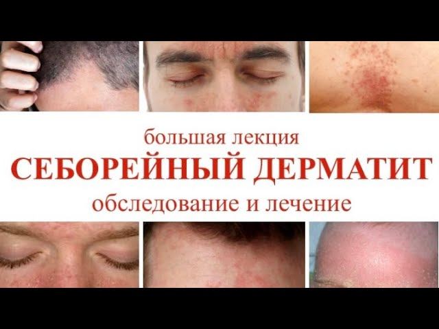 Новая большая лекция по СЕБОРЕЙНОМУ ДЕРМАТИТУ (60мин)