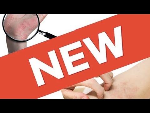 АТОПИЧЕСКИЙ ДЕРМАТИТ: новый стандарт лечения