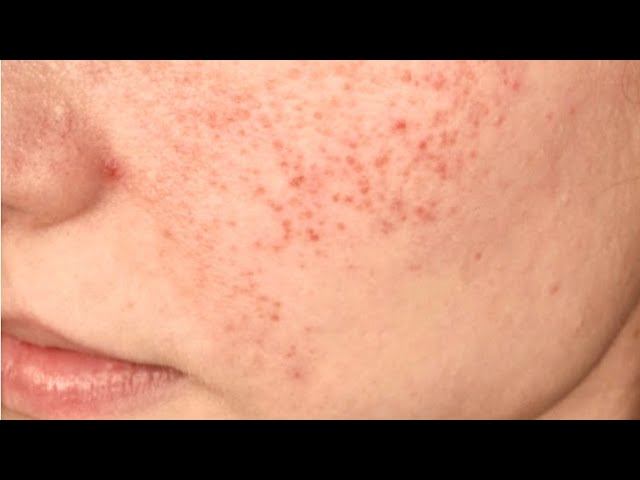 ГРАНУЛЕМАТОЗНАЯ/ГИПЕРТРОФИЧЕСКАЯ/ФИМАТОЗНАЯ РОЗАЦЕА: эффективное лечение (видео-лекция 50мин)