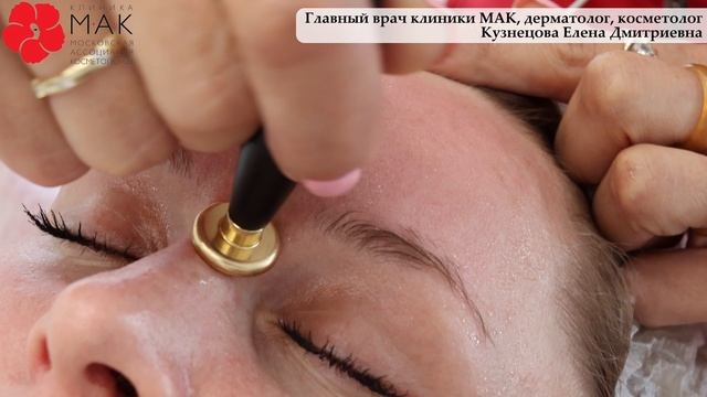 Иннофилл монополярный РФ