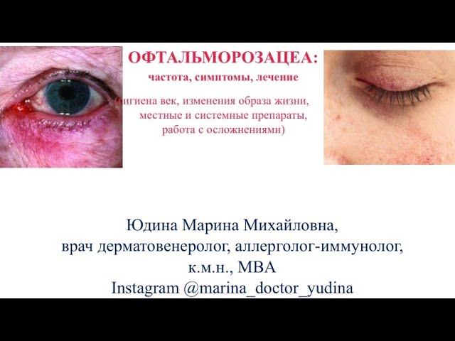 ОФТАЛЬМОРОЗАЦЕА: лекция 50 минут