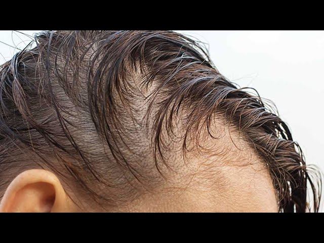 Болезни кожи головы: себорея, псориаз, дерматит, атопия, микозы (550р,  ссылка в первом комментарии)