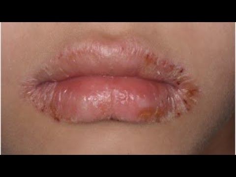 Хейлиты: почему сохнут и шелушатся губы