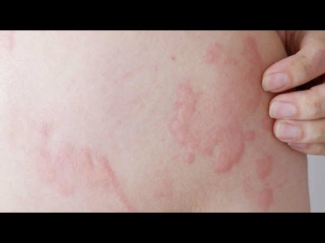 АЛЛЕРГИЯ: поллиноз и крапивница