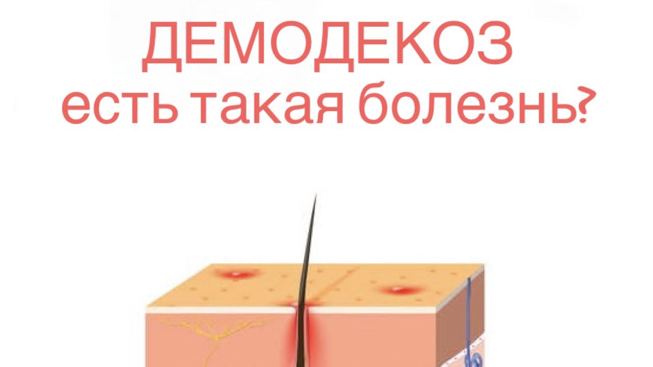 ДЕМОДЕКОЗ и ДЕМОДЕКС - что это такое