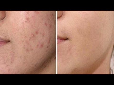 Вернется ли АКНЕ после РОАККУТАНА?  % рецидивов (возвращения угрей) после курса ретиноидов