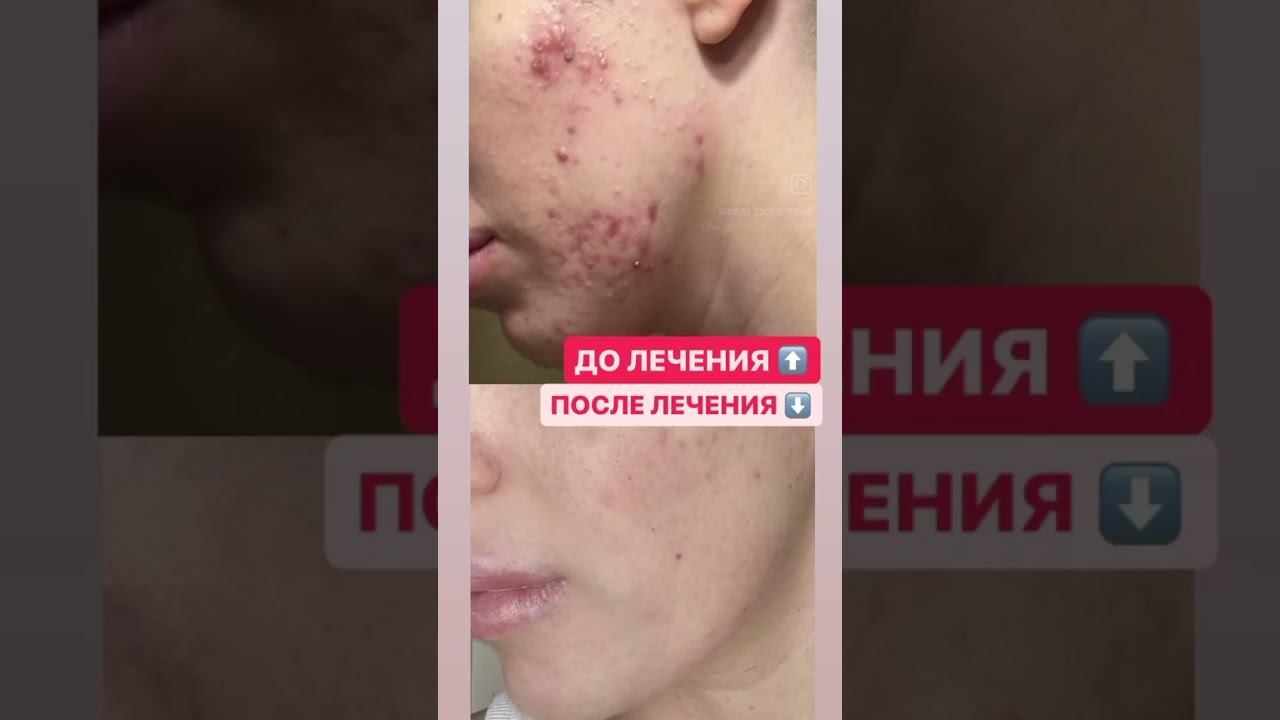 ДО и ПОСЛЕ лечения у доктора Юдиной М.М.