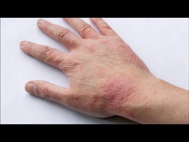 АТОПИЧЕСКИЙ ДЕРМАТИТ: что нового за последние 3 года