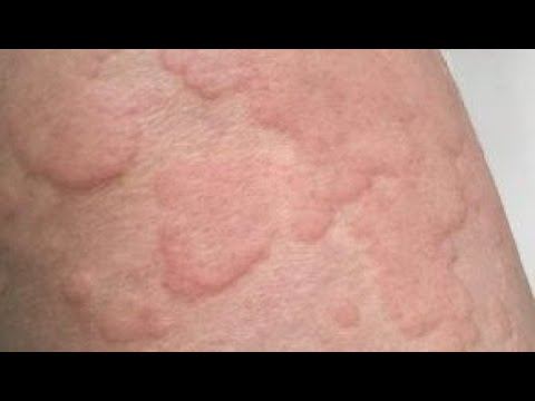 ОСТРАЯ КРАПИВНИЦА И ОТЕК КВИНКЕ: причины, анализы, лечение