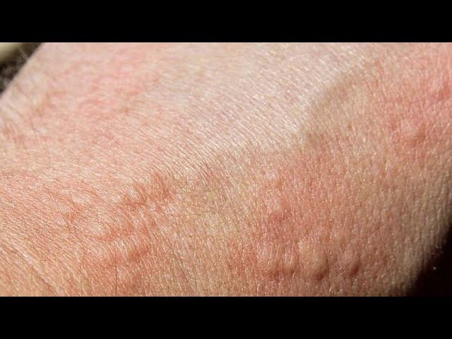 ХРОНИЧЕСКАЯ КРАПИВНИЦА